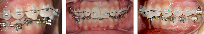 case4-01 « Roncone Orthodontics International