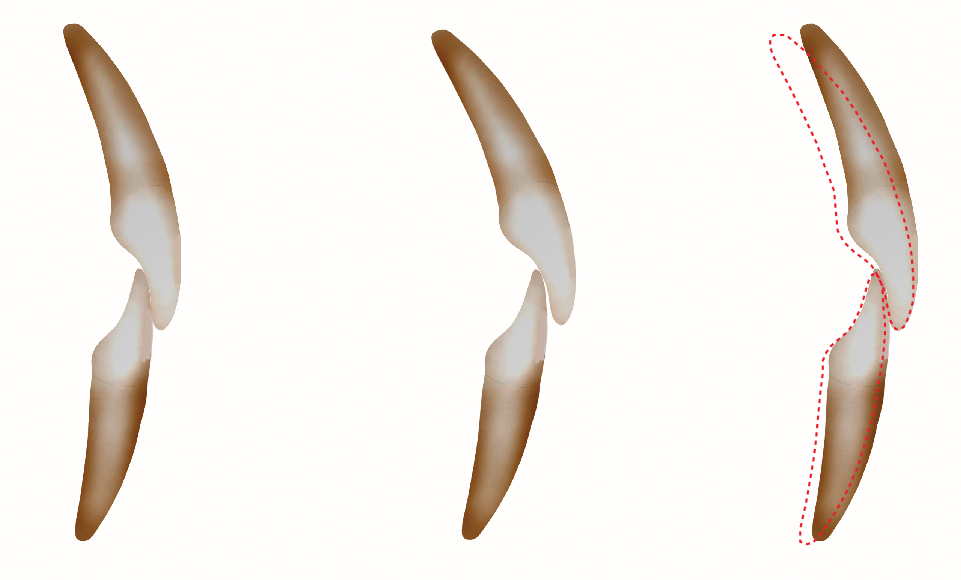 side by side comparison Roncone overjet « Roncone Orthodontics ...