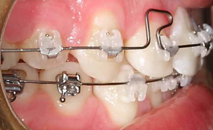 16 weeks after initial activation « Roncone Orthodontics International