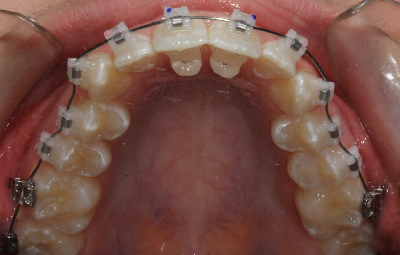 bite ramps intraoral 2 « Roncone Orthodontics International