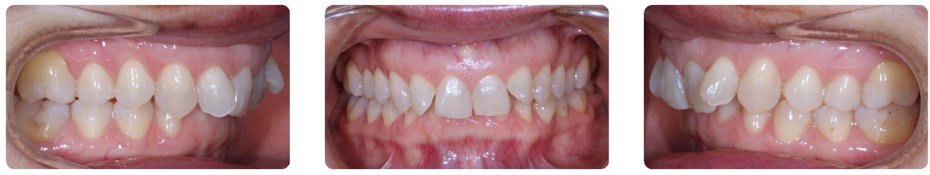 The PDS Wires « Roncone Orthodontics International