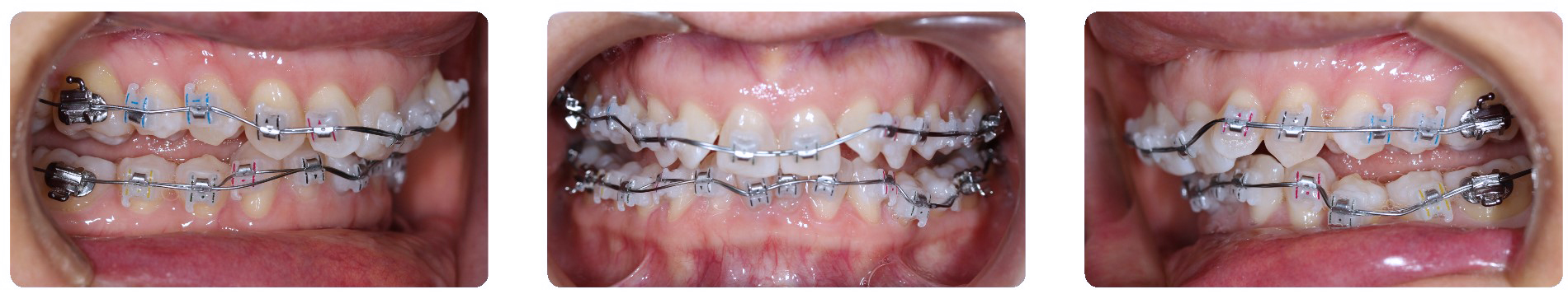 The PDS Wires « Roncone Orthodontics International