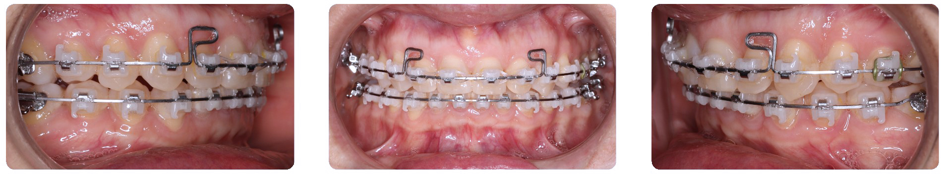 The PDS Wires « Roncone Orthodontics International